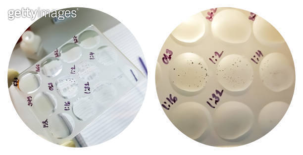 College of two image of RPR, VDRL, Syphilis test glass slide ...