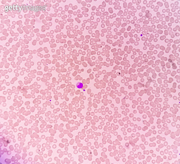 Microscopic blood picture of dengue affected patient. thrombocytopenia ...