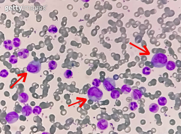 Chronic myelocytic leukemia (CML). Hematology. Photomicrograph. 이미지 ...