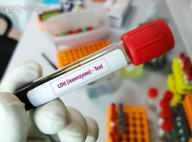 Blood sample tube for LDH (isoenzyme) test. lactate dehydrogenase ...