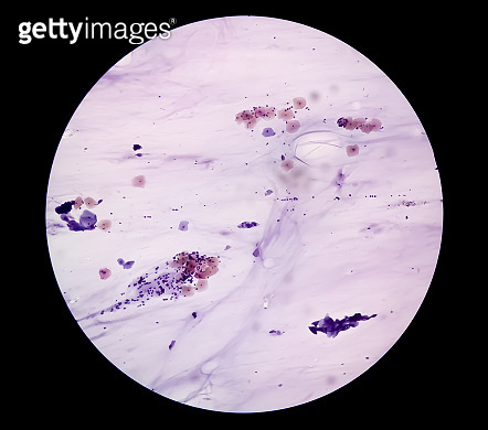 Microscopic view of normal human cervix cells. Squamous epithelial ...