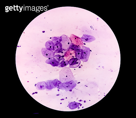Microscopic view of normal human cervix cells. Squamous epithelial ...