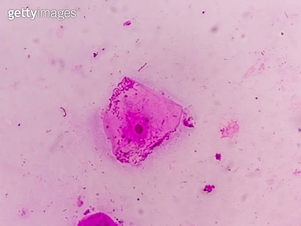 High Vaginal Swab (HVS) gram stain microscopic 100x show few pus cells ...