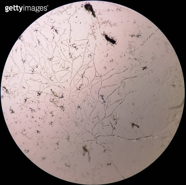 Microscopic view of dermatophytes. fungus test. 10X. Diagnosis for ...