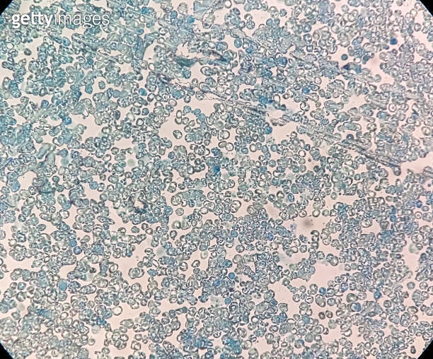 Reticulocyte count from blood smear (methylene blue staining ...