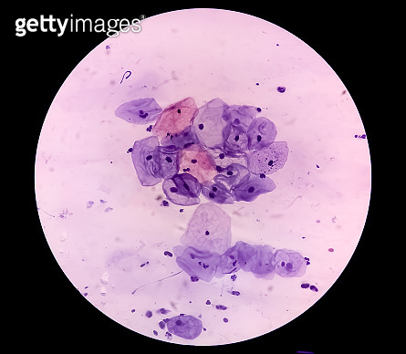 Microscopic view of normal human cervix cells. Squamous epithelial ...