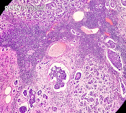 Photomicrograph of a breast core biopsy showing an invasive ductal ...