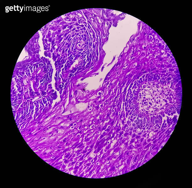 Colon Cancer: Photomicrograph (microscopic image) of an invasive ...