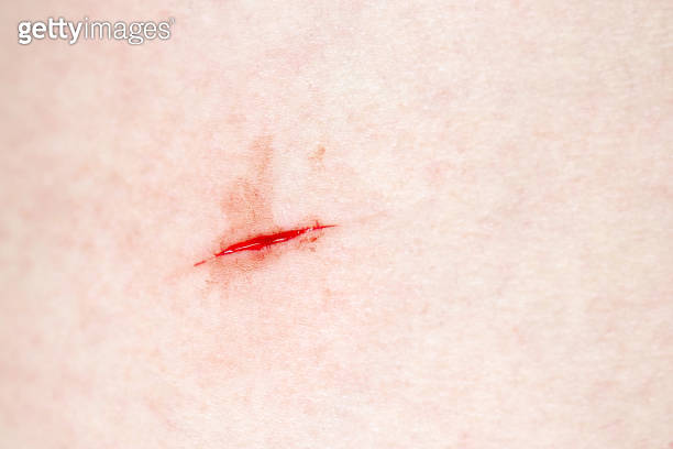 Cut on the body. Fresh wound on the leg with blood, skin texture. Woman ...