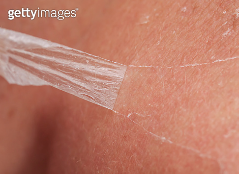 texture of problematic human skin close-up with burn, redness and ...