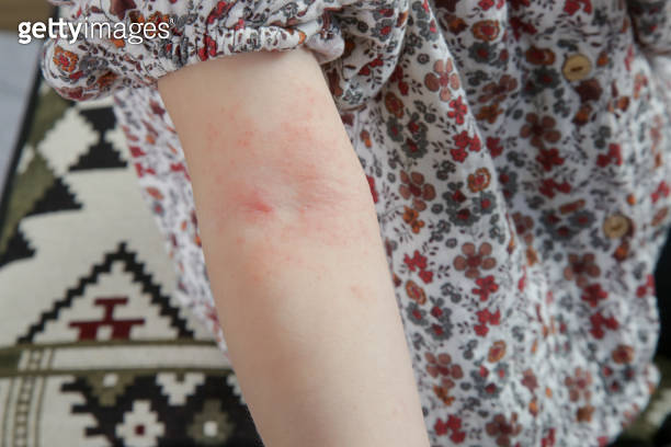 Toddler girl suffering from atopic dermatitis, close up image. Red and ...