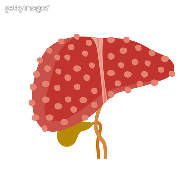 liver and liver disease. cirrhosis of the liver, hepatitis, fatty ...