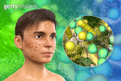 Acne, pimples, and closeup view of bacteria, the causative agents of ...