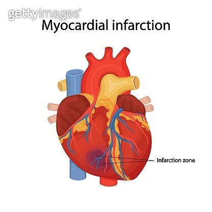 Myocardial infarction. illustration of a human heart. Heart attack ...