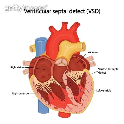 Ventricular septal defect (VSD). Congenital heart defect. cartoon ...