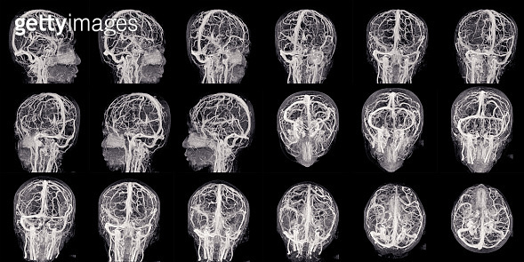 MRA AND MRV OF THE BRAIN The MRA shows small group of prominent ...