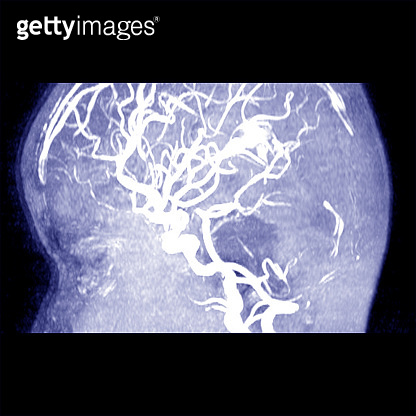 MRI THE BRAIN.Moderate perilesional vasogenic edema with 0.7 cm midline ...