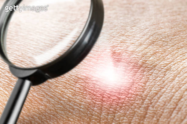 Sun burned skin concept: human skin being burned by UV rays (1406880295 ...