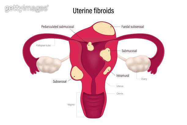 Uterine fibroid locations. Pedunculated submucosal, Fundal subserosal ...