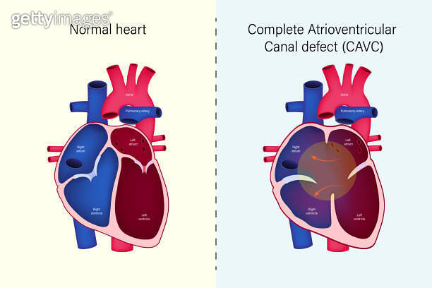 The difference of Normal heart and Complete Atrioventricular Canal ...