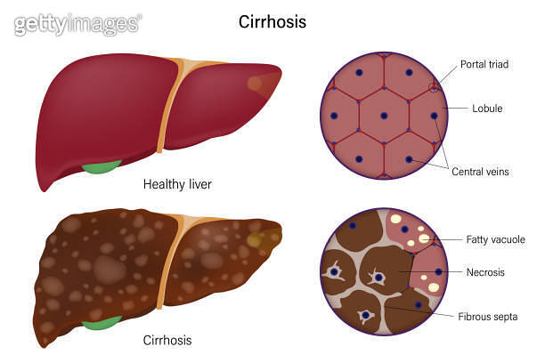 Liver histology. Normal liver and cirrhosis liver. Liver disease for ...