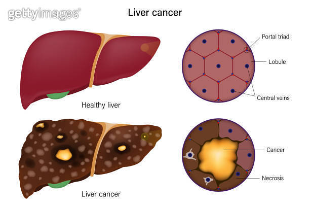 Liver histology. Normal liver and liver cancer. Liver disease for medical education and science ...