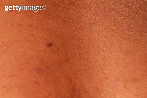 human skin texture. wart and pimples on skin micro photo. close up ...