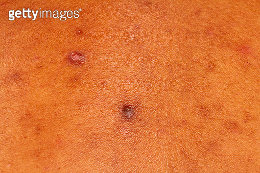 human skin texture. wart and pimples on skin micro photo. close up ...