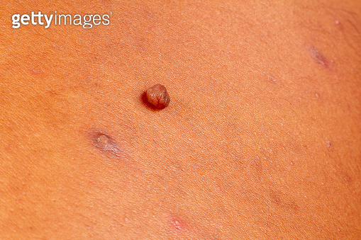 human skin texture. wart and pimples on skin micro photo. close up ...
