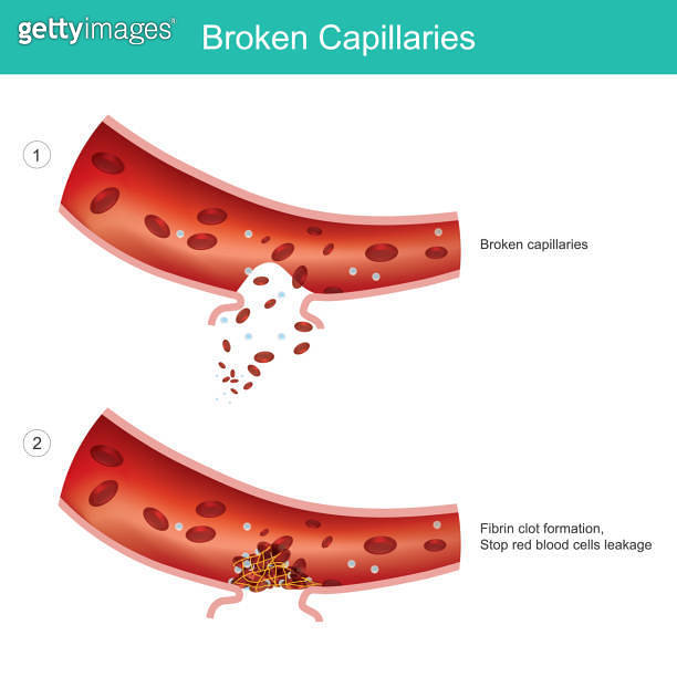 Broken capillaries. caused from blood capillaries expand too much ...