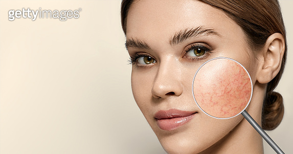 Magnifying glass showing couperose on face skin. Woman showing problems ...