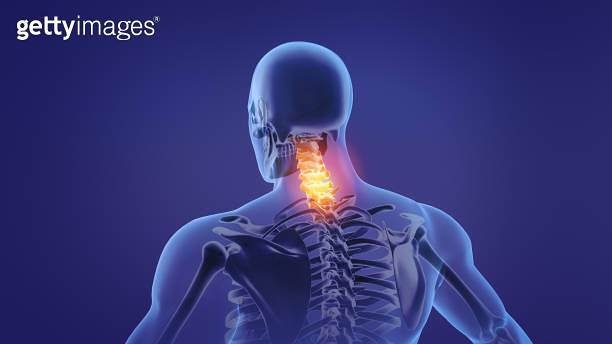 Animation of a painful neck 이미지 (1398087542) - 게티이미지뱅크