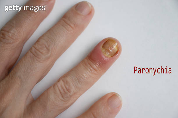 Paronychia disease of the fingernail 이미지 (1415032281) - 게티이미지뱅크