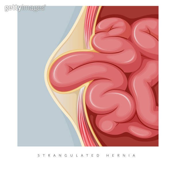 Strangulated Hernia - Section of the Small Intestines - Stock ...