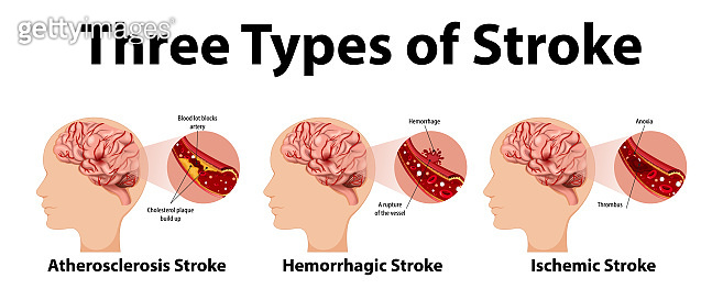 Infographic of common types of stroke (1403936611) 일러스트, 무료 일러스트 - 게티이미지뱅크