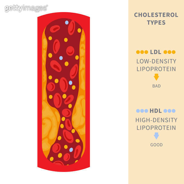 Cholesterol plaque buildup in blocked artery diagram (1443261782) - 게티이미지뱅크