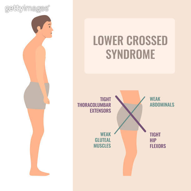 Crooked man with lower crossed syndrome imbalance (1402684586) - 게티이미지뱅크