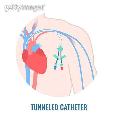 Tunneled central line venous catheter close up 이미지 (1394911263) - 게티이미지뱅크