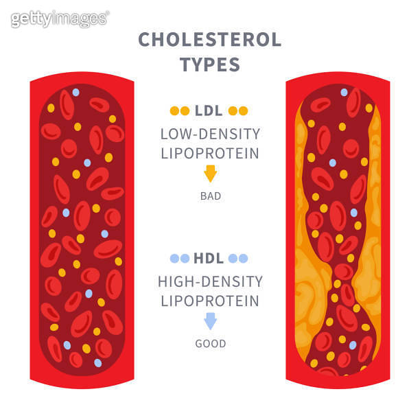 Normal and blocked artery with cholesterol clot infographics ...
