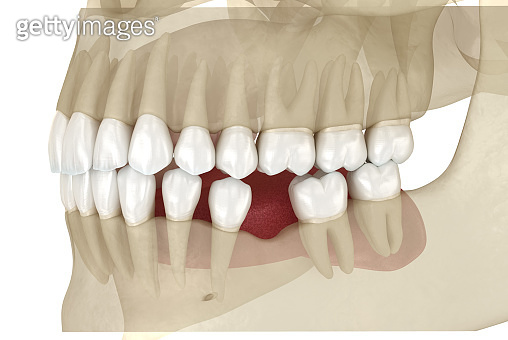 Teeth shift deformatiuon after losing molar tooth. 3D illustration of ...