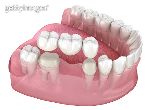 Dental bridge of 3 teeth over molar and premolar. Medically accurate 3D ...