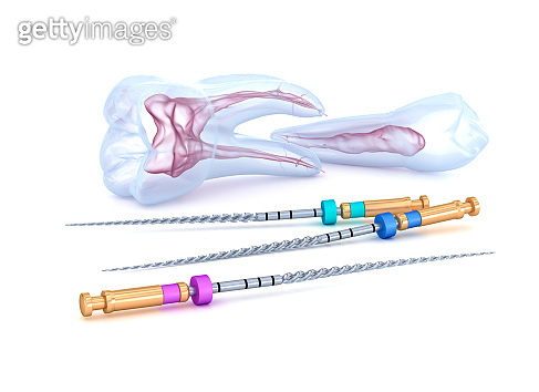 Endo concept on white. Dental 3D illustration (1395160501) - 게티이미지뱅크