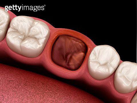The blood clot seals off the tooth after extraction. Dental 3D ...