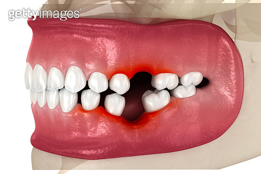 Teeth shift deformatiuon after losing molar tooth. 3D illustration of ...
