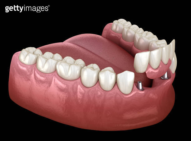 Frontal teeth bridge supported by implants. Medically accurate 3D ...
