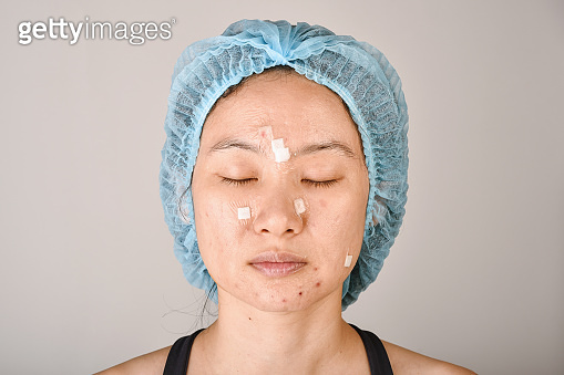 Facial skin problem, Acne disease in adult, Close up woman face with ...