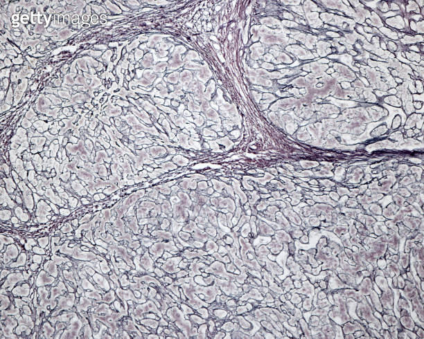 Human liver. Cirrhosis. Silver stain (1382279340) - 게티이미지뱅크