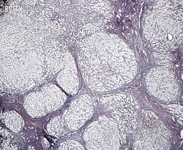 Human liver. Cirrhosis. Silver stain (1383511417) - 게티이미지뱅크