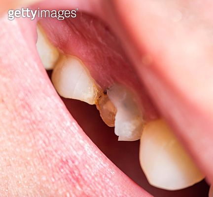 Damaged tooth enamel and chipped tooth piece. Dental restoration with ...