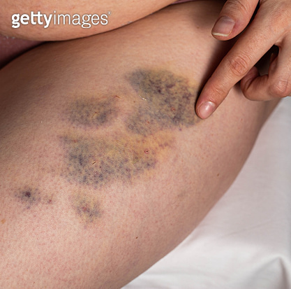 Treatment of bruises, bumps and seals after injections with therapeutic ...